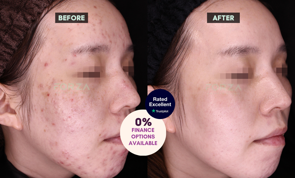 Laser Acne Scarring Removal